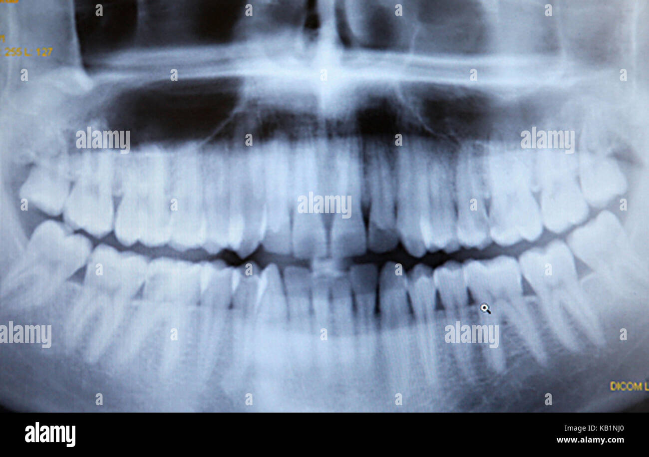 X ray picture of a human bite hi-res stock photography and images - Alamy
