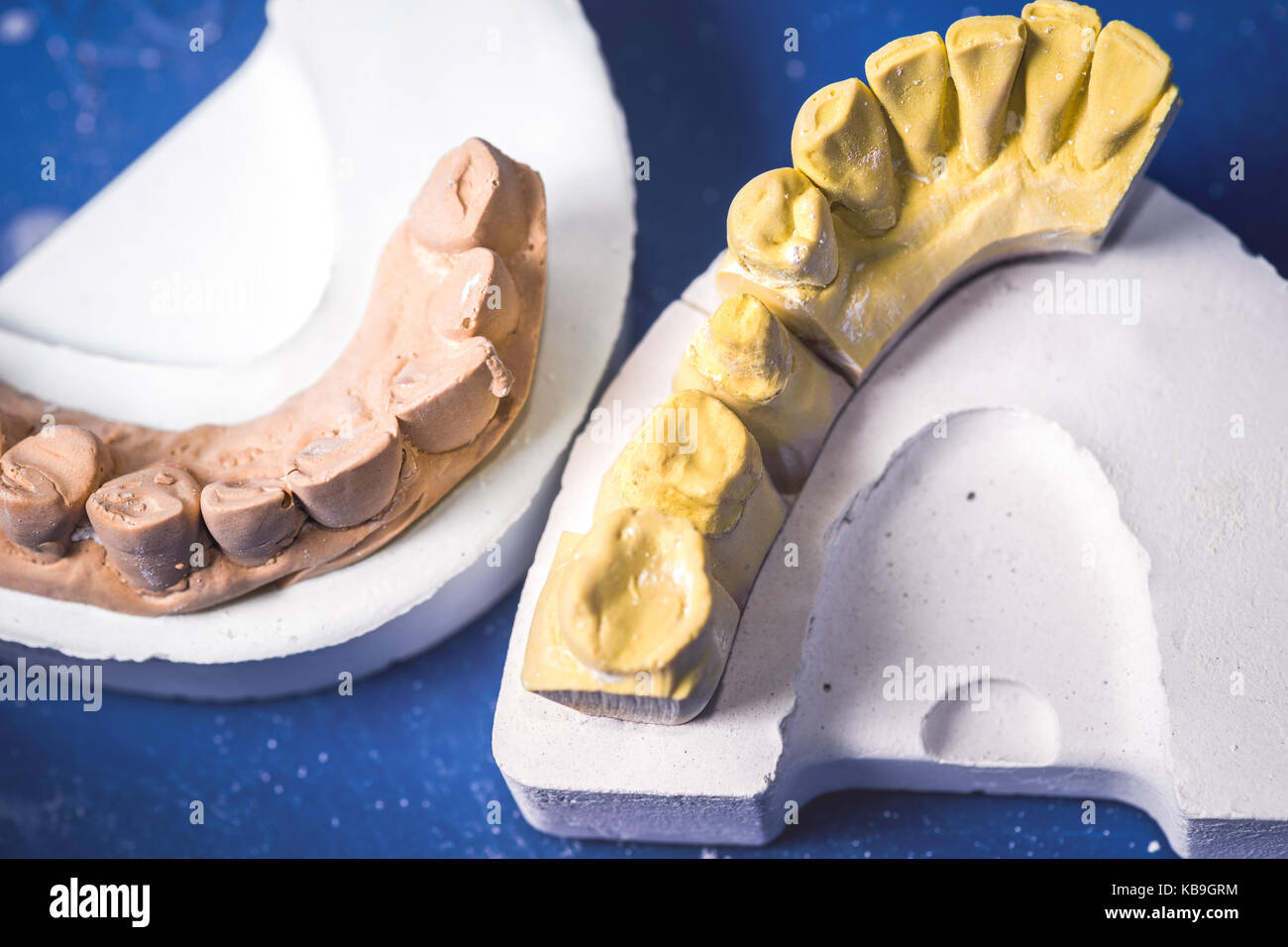 Dental prosthesis, artificial tooth. Photo of artificial teeth made in ...