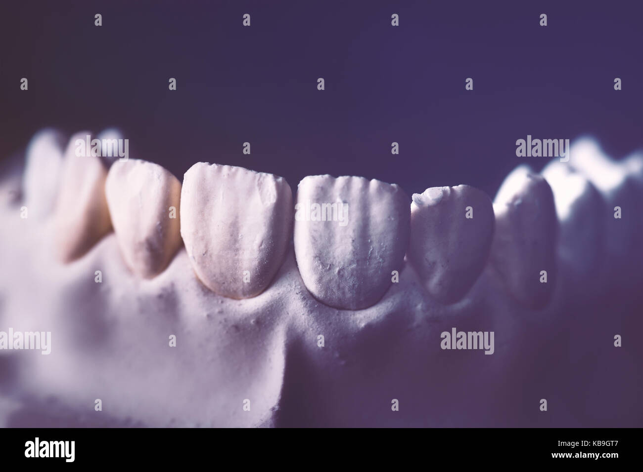 Dental prosthesis, artificial tooth. Photo of artificial teeth made in ...