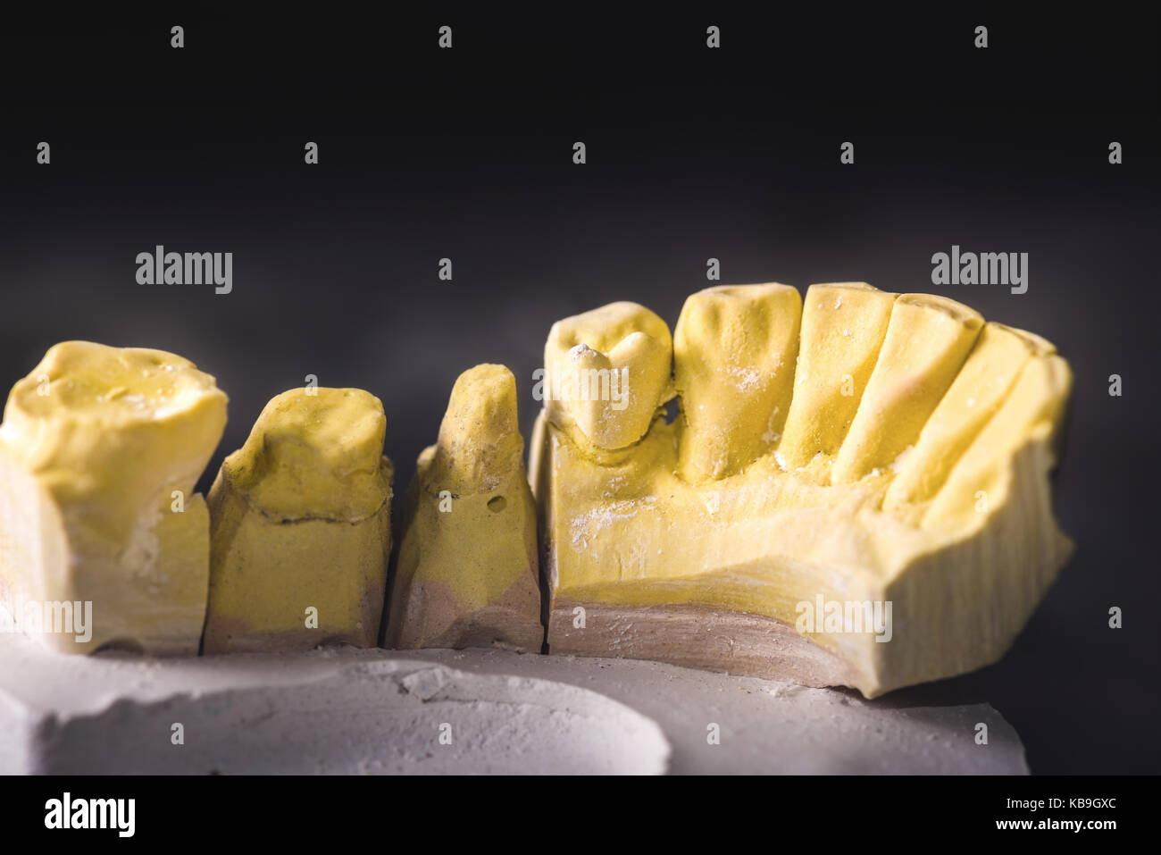 Dental prosthesis, artificial tooth. Photo of artificial teeth made in ...