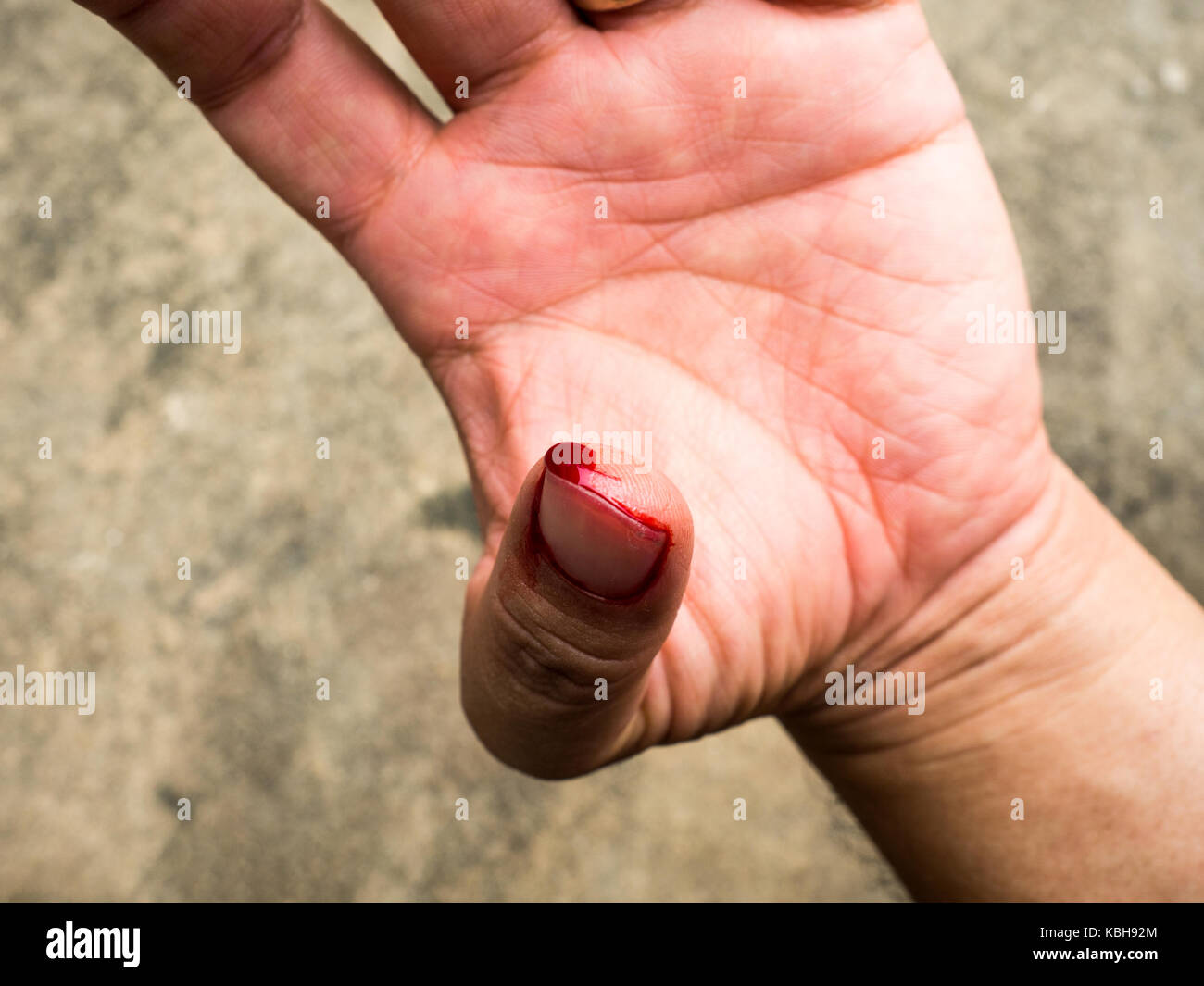 Hand Cut Blood Bleeding High Resolution Stock Photography and Images ...