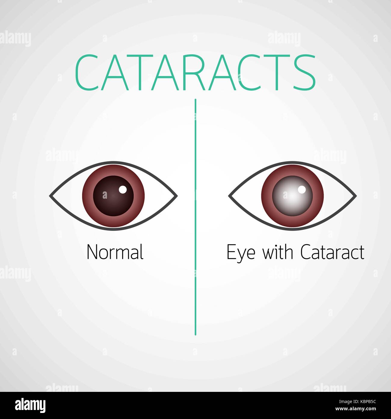 Glaucoma illustration hi-res stock photography and images - Alamy