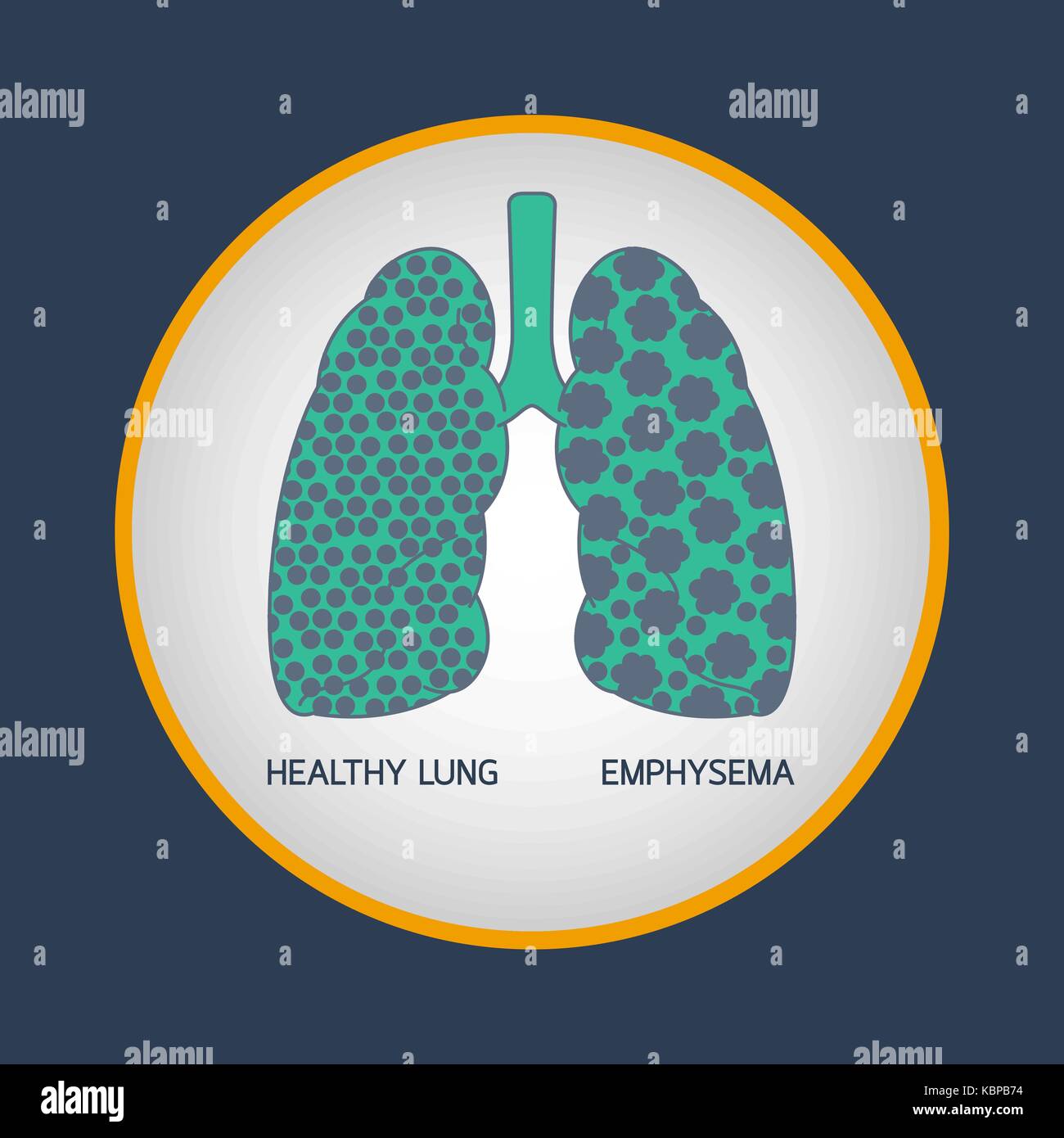 Emphysema hi-res stock photography and images - Alamy