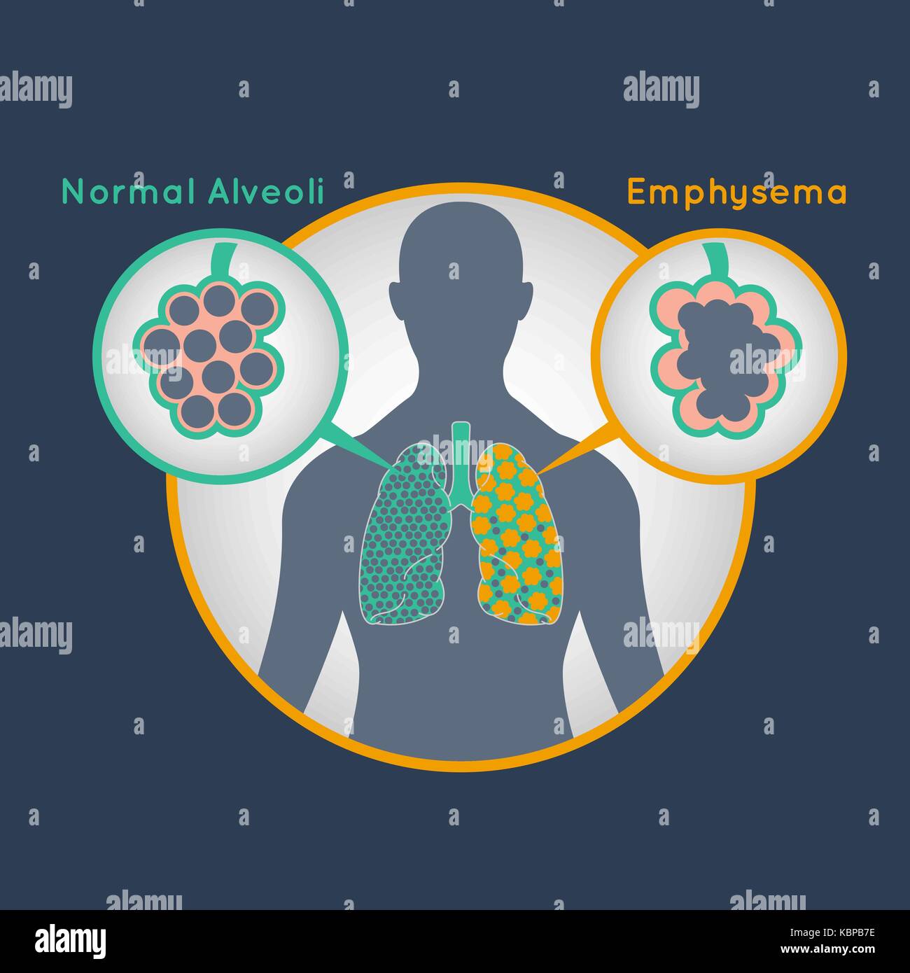 Emphysema hi-res stock photography and images - Alamy