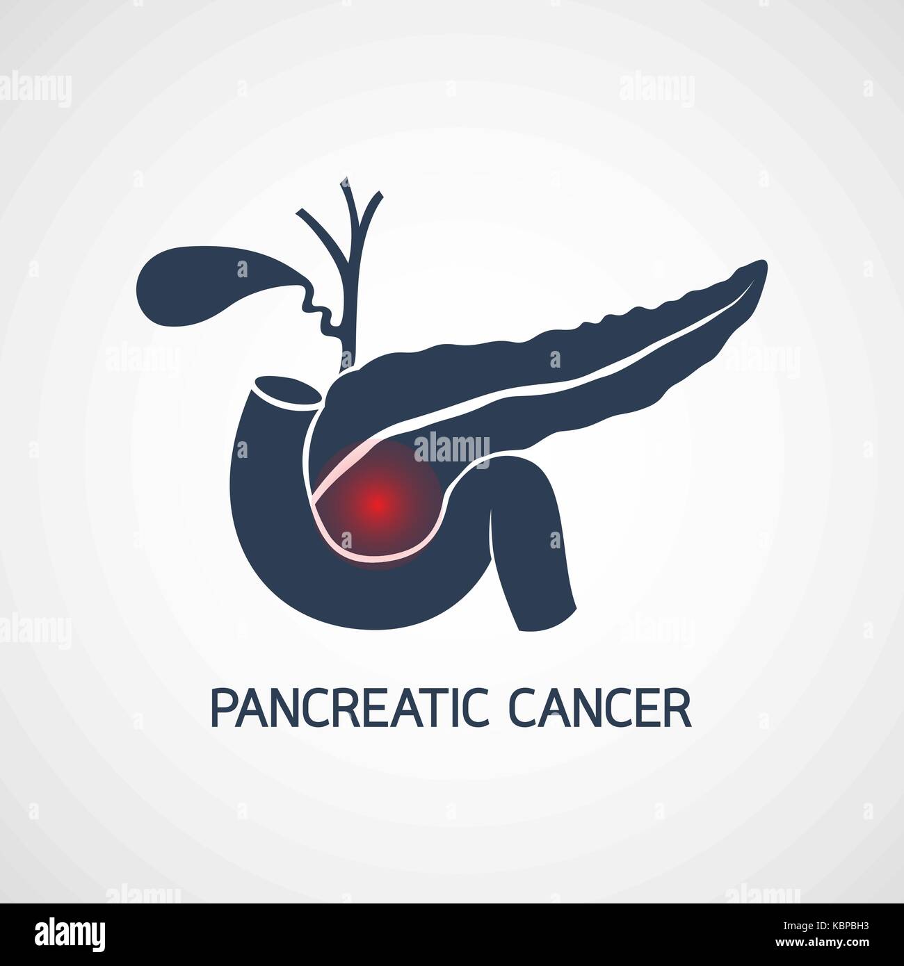 Pancreas cancer Stock Vector Images - Alamy