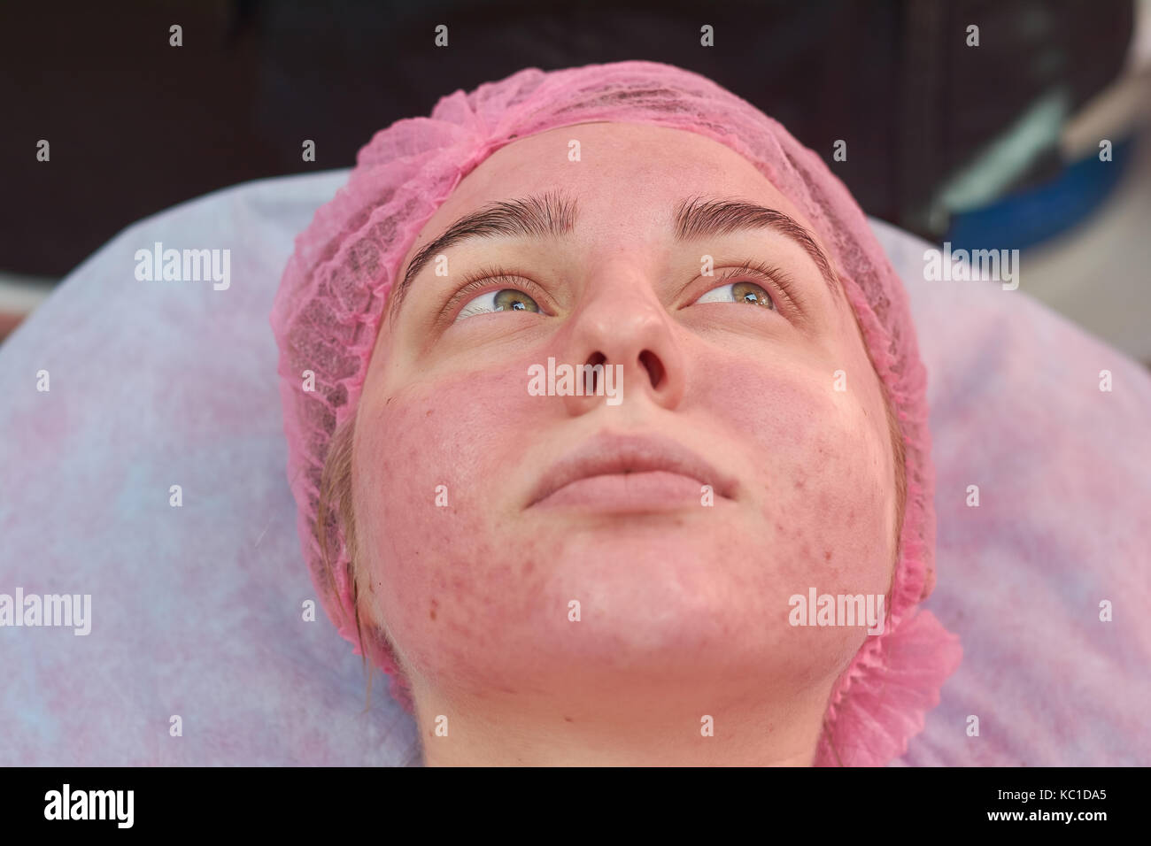 Face acne doctor hi-res stock photography and images - Alamy