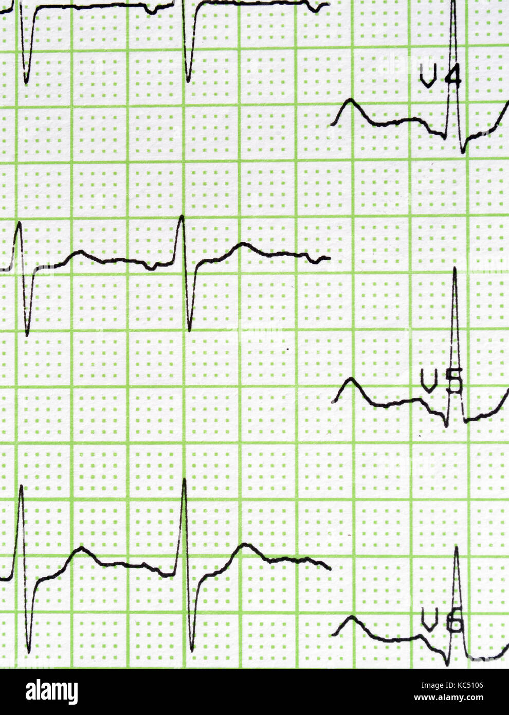 Electrocardiogram test that shows electrical activity of the heart ...
