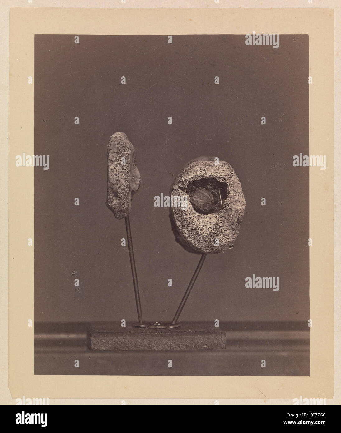 Excised Knee Joint. A Round Musket Ball in the Inner Condyle of the ...