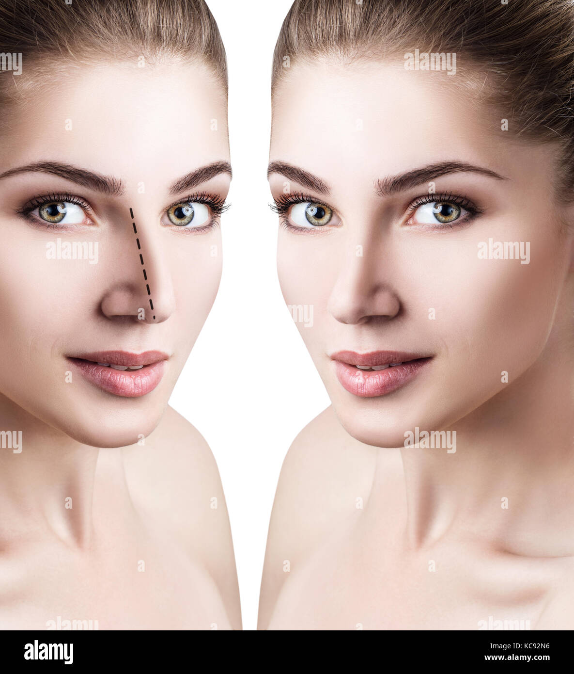 Female nose before and after cosmetic surgery Stock Photo - Alamy