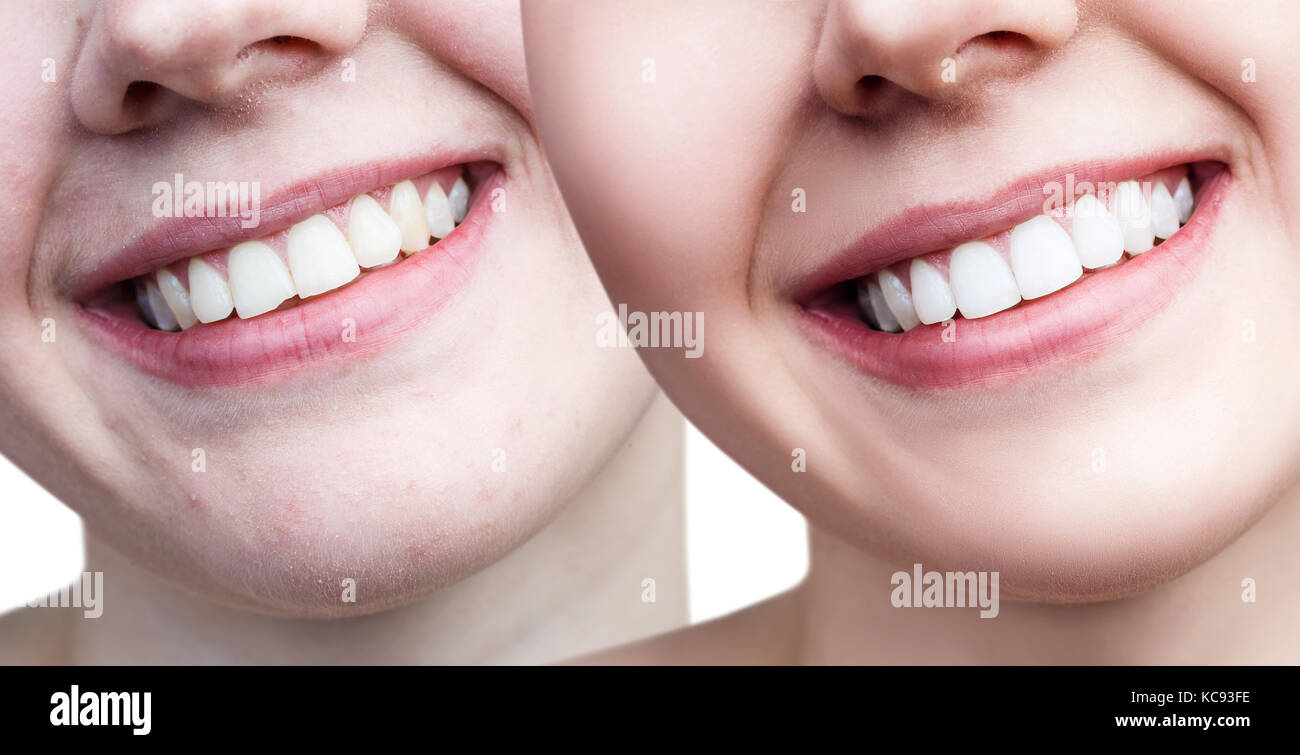 Teeth before and after hi-res stock photography and images - Alamy