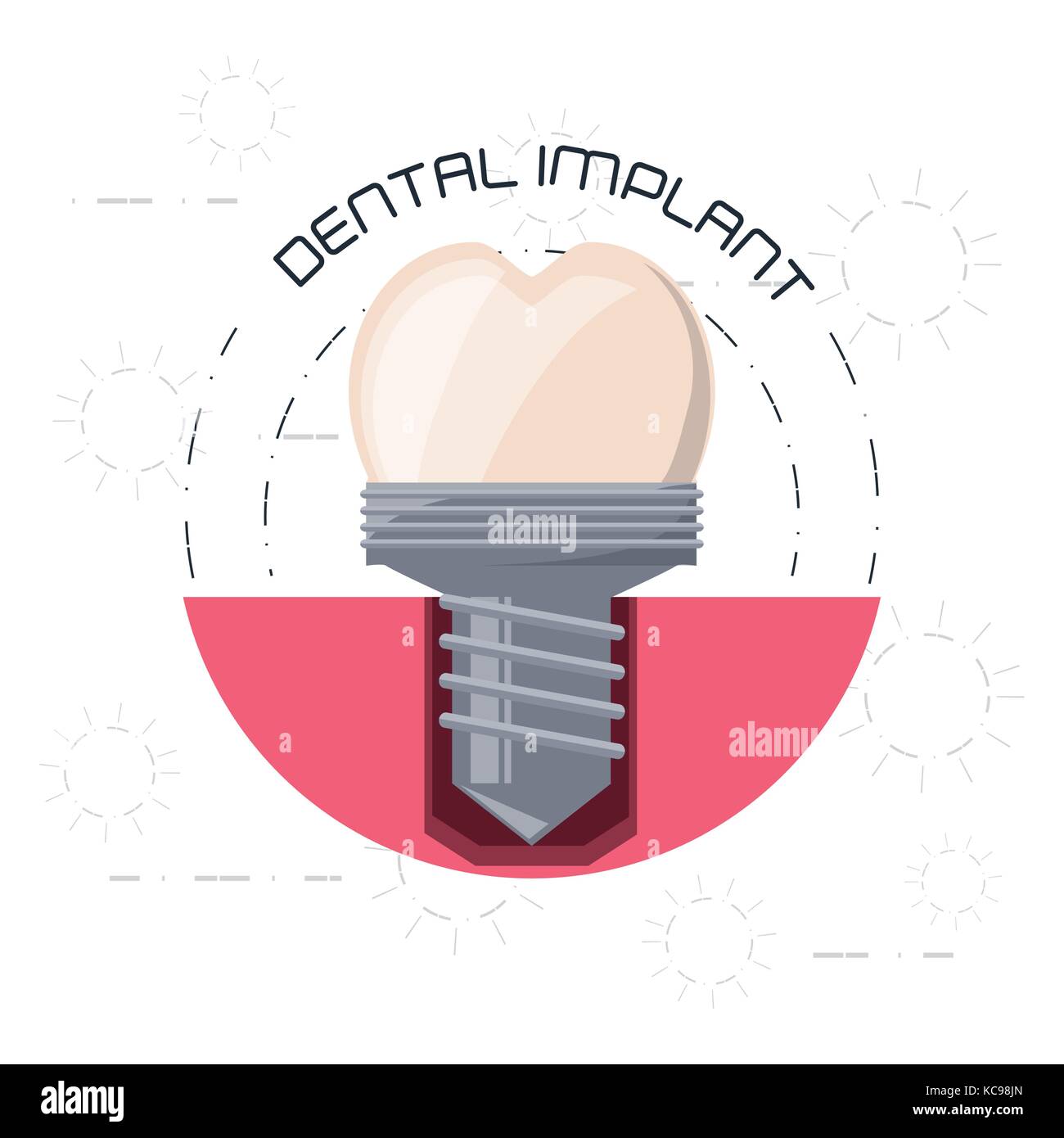 Dental implant medical procedure Cut Out Stock Images & Pictures - Alamy