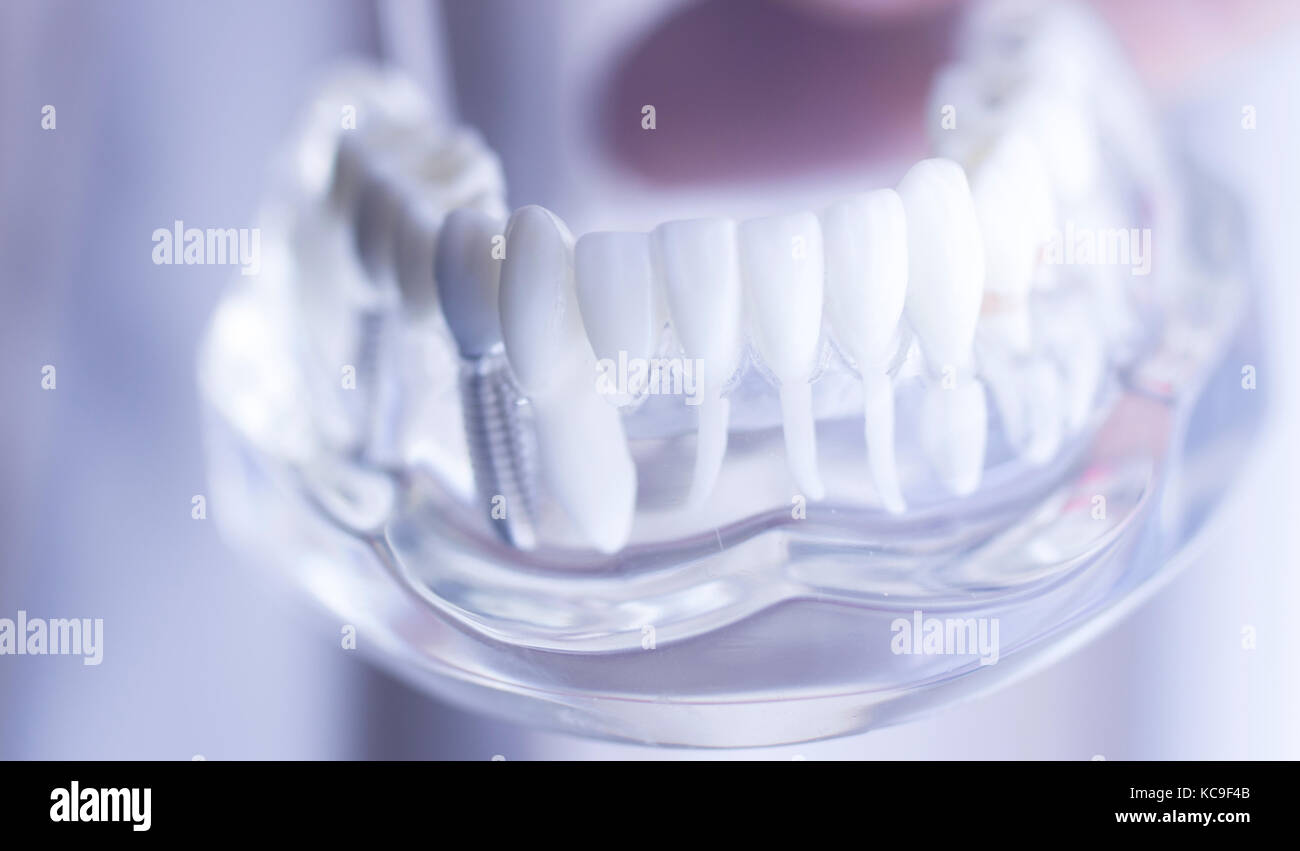 Dental teeth mouth dentists teaching model with teeth, gums, molars and ...