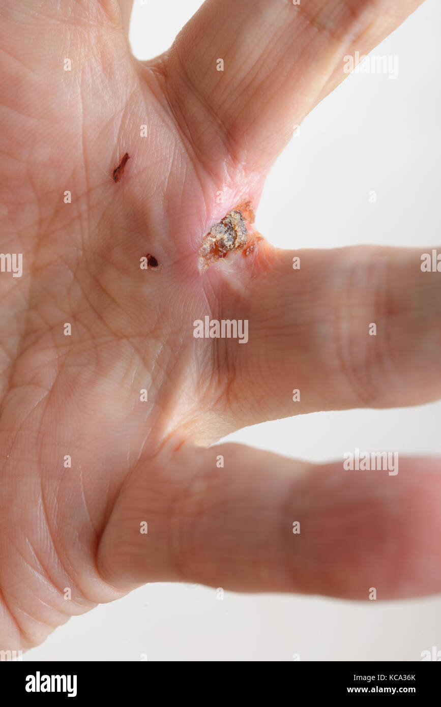Dog bite scar hi-res stock photography and images - Alamy