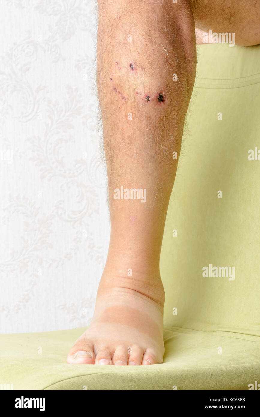 Deep scar tissue hi-res stock photography and images - Alamy