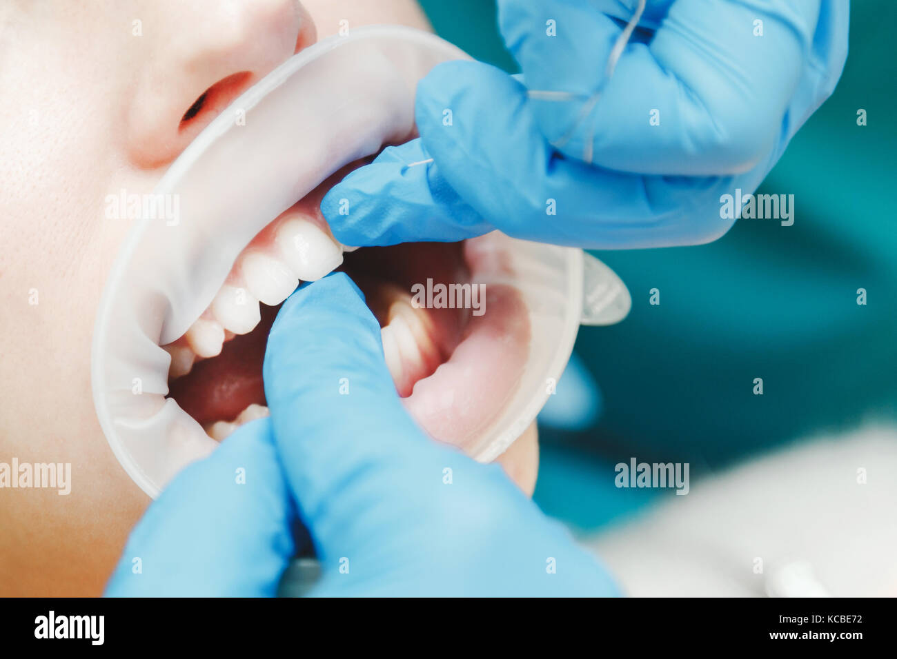 Close up of female mouth with retractor. Doctor flossing the teeth ...