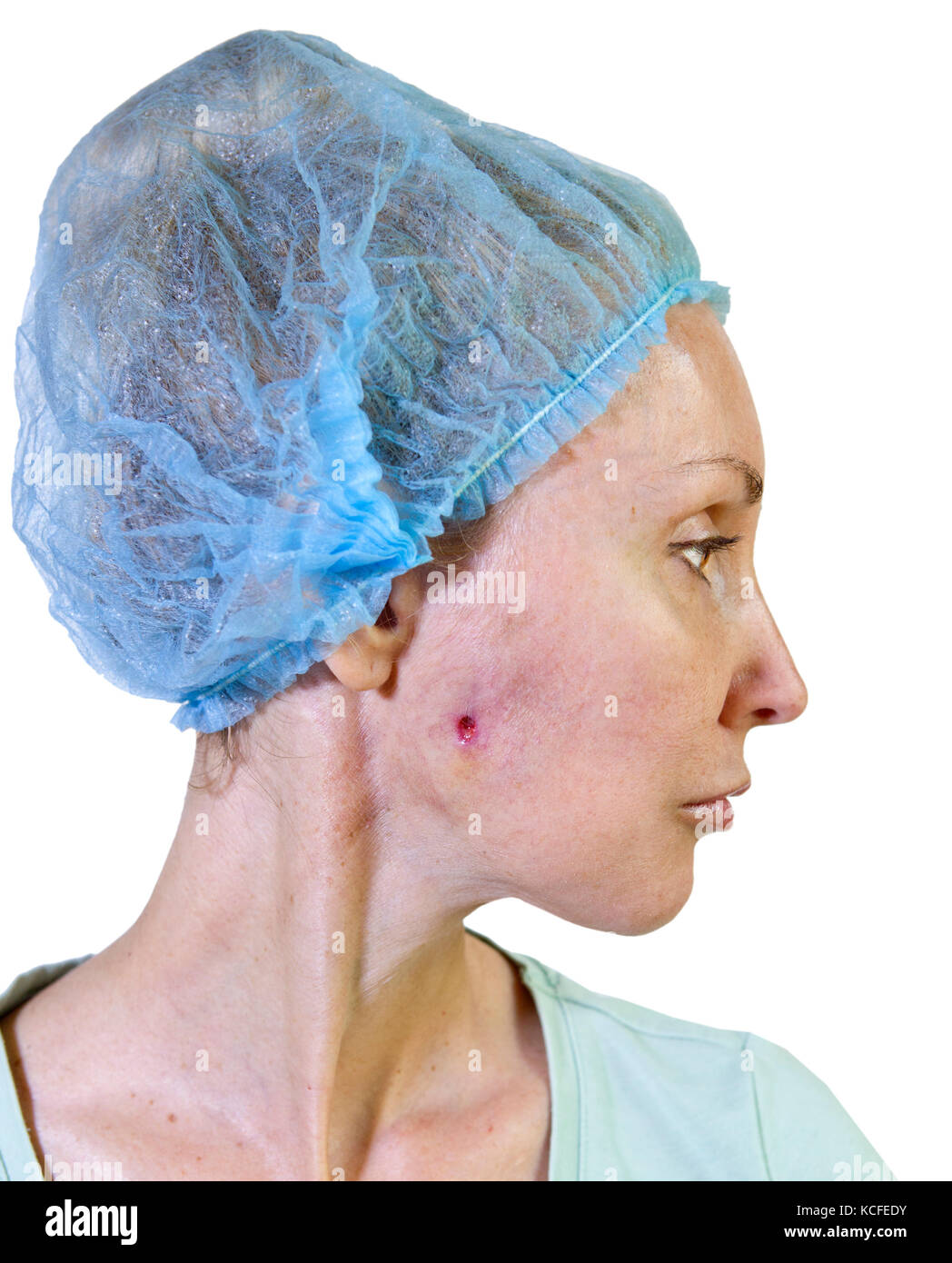 Photo from a series: Cosmetology. Complications. wound after a fistula ...
