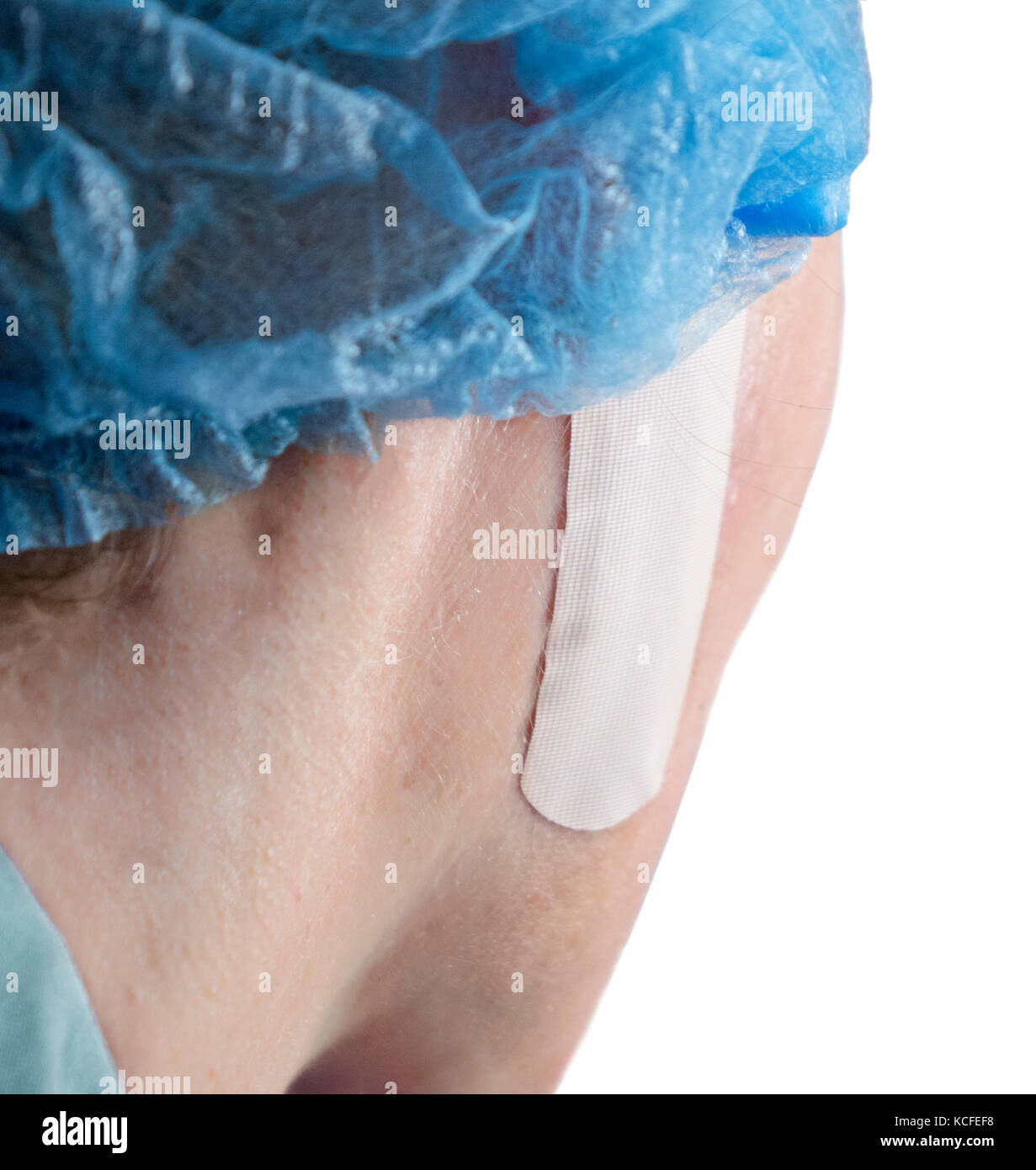 Photo from a series: Cosmetology. Complications. wound after a fistula ...