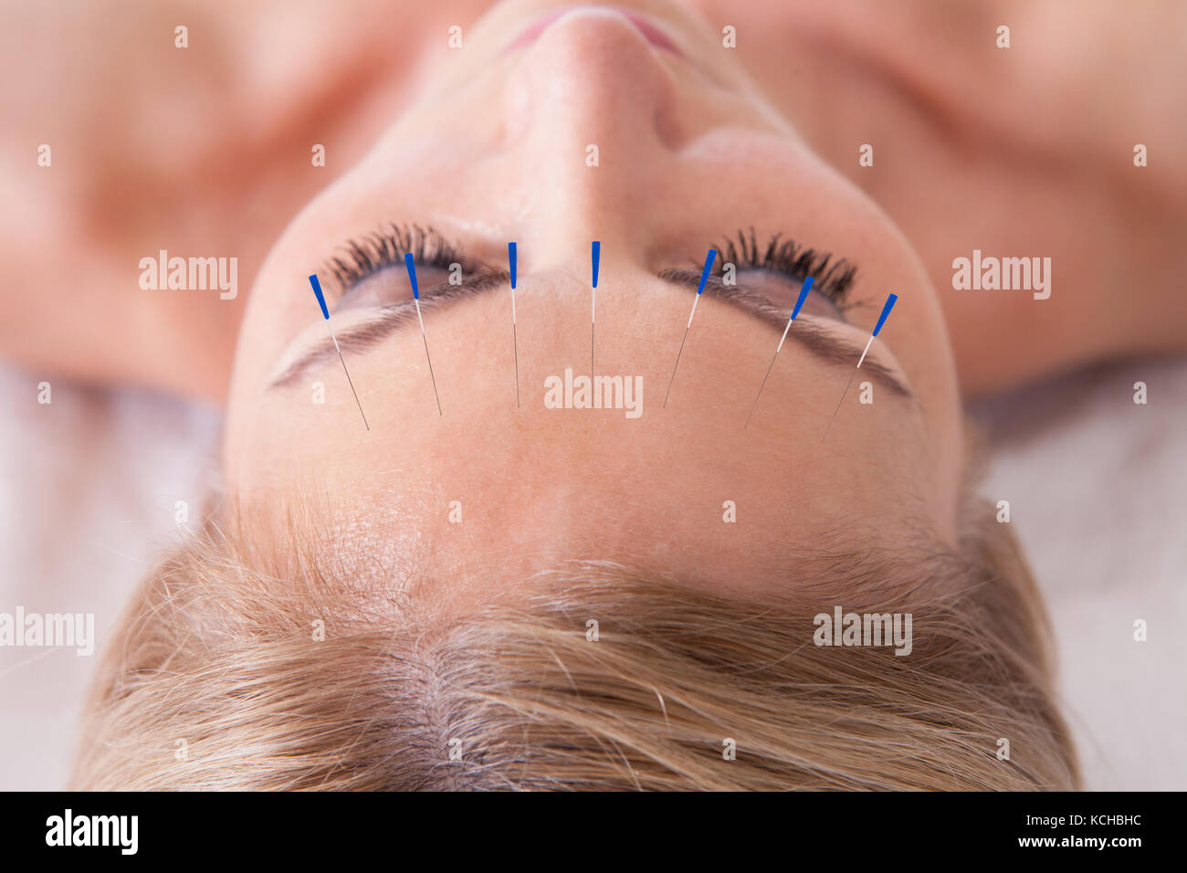 Acupuncture therapy face hi-res stock photography and images - Alamy