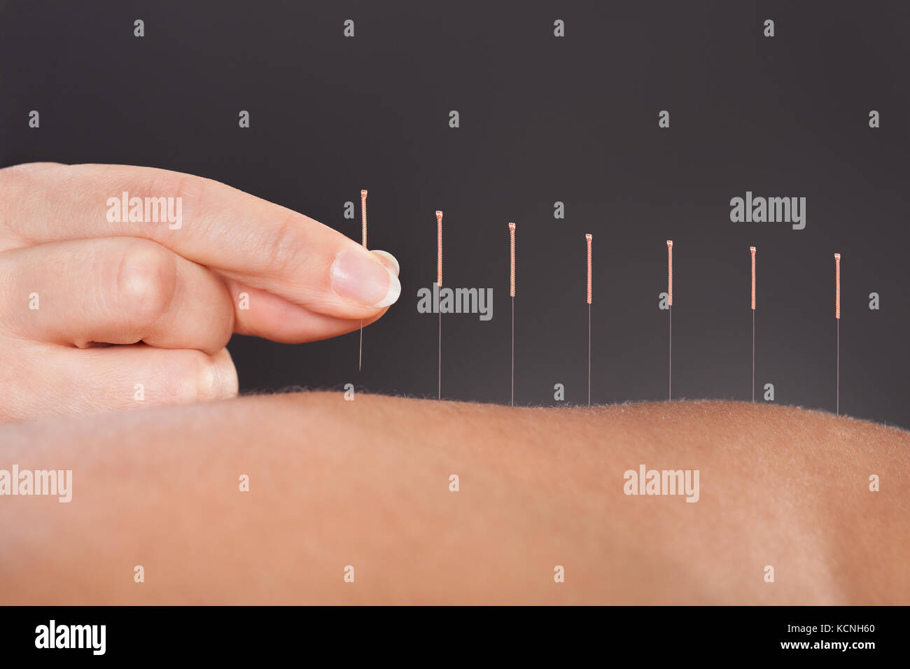 Close-up Of A Person Getting An Acupuncture Treatment At Spa Stock ...