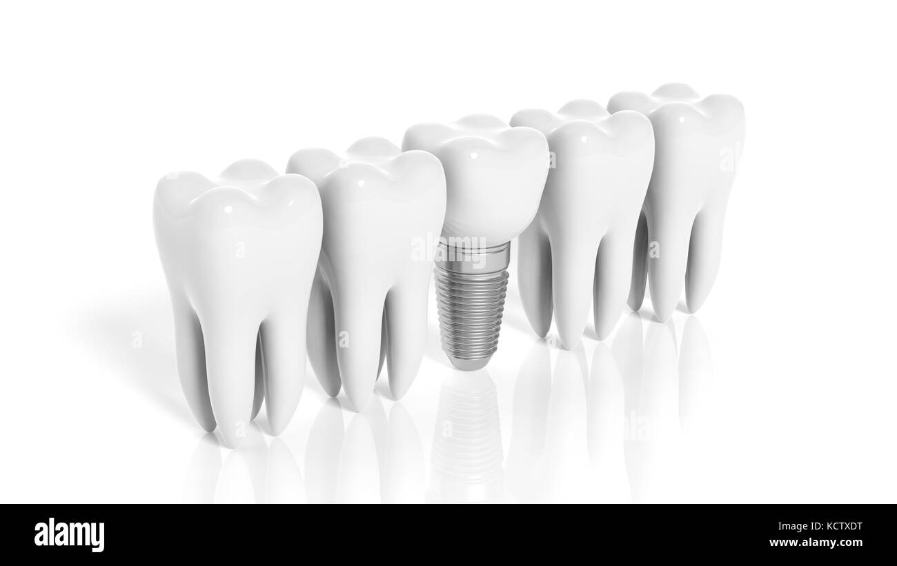 Row of teeth and dental implant isolated on white background Stock ...