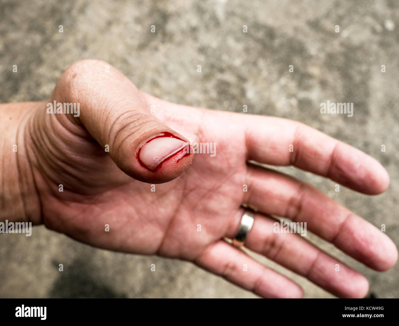 Hand Cut Blood Bleeding High Resolution Stock Photography and Images ...