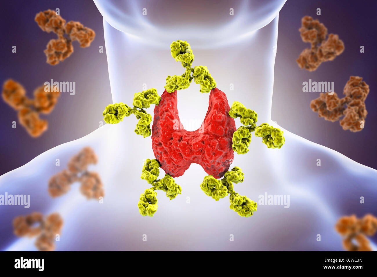 Autoimmune thyroiditis (Hashimoto's disease), conceptual illustration ...