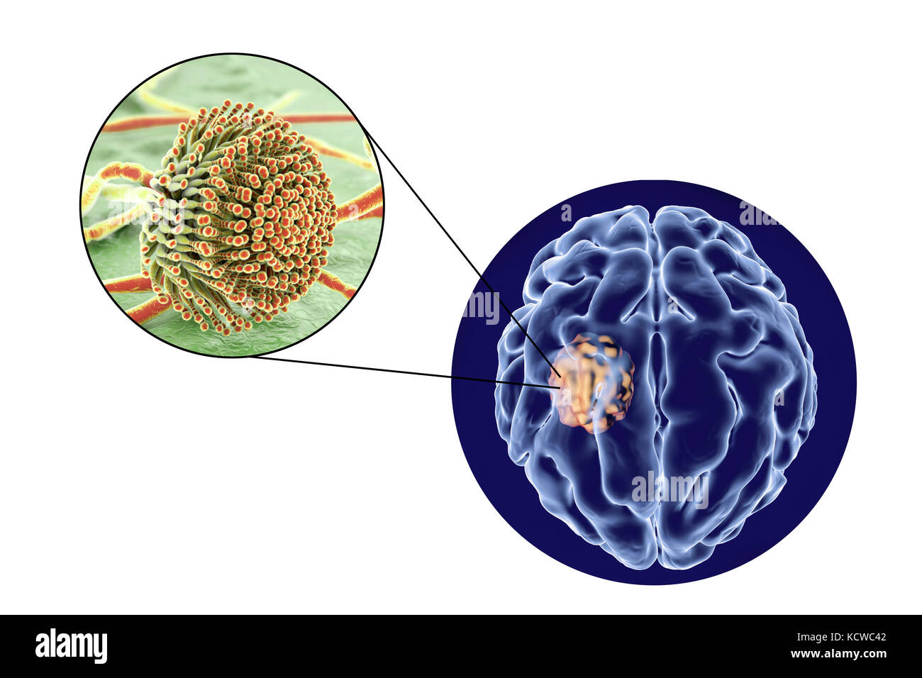 Aspergilloma of the brain and close-up view of Aspergillus fungi ...