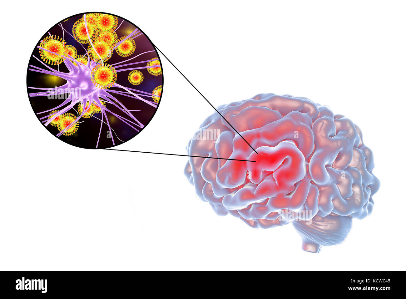 Viral encephalitis. Conceptual illustration showing brain and close-up ...