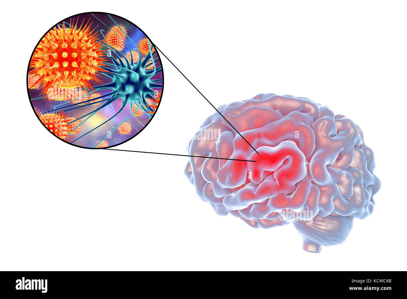 Viral encephalitis. Conceptual illustration showing brain and Stock ...