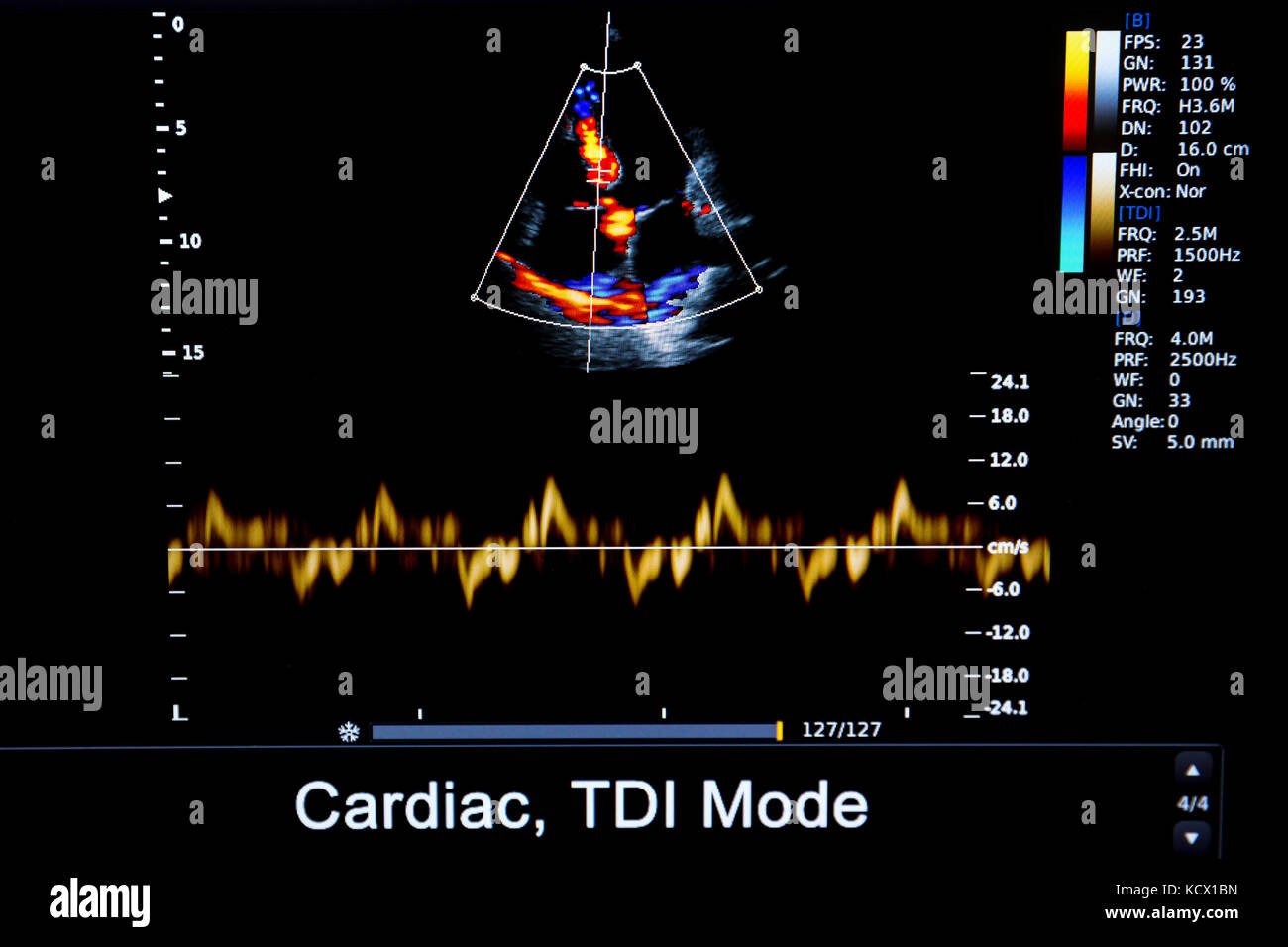 Colourful image of modern ultrasound monitor. Ultrasonography machine ...