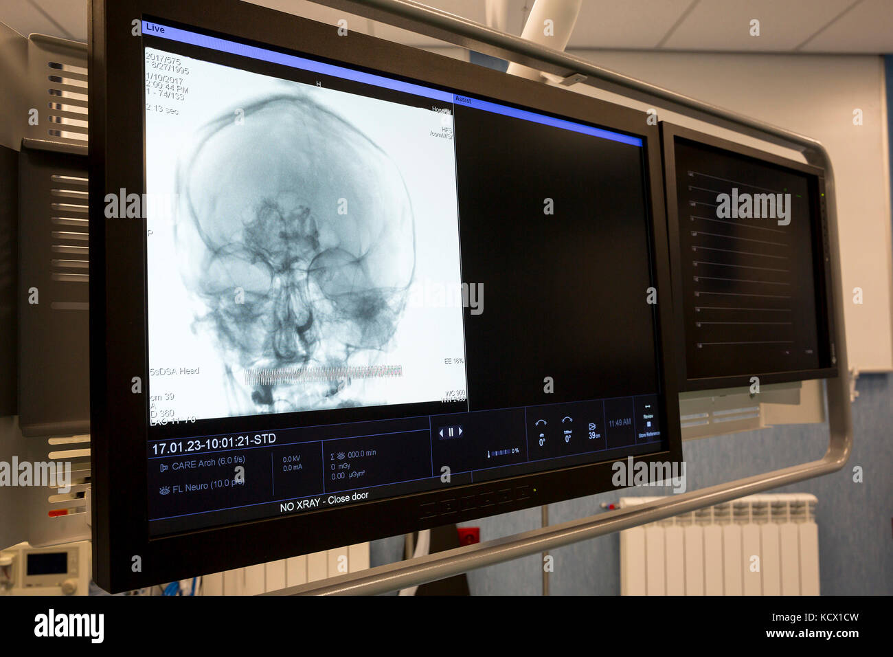 Human head X-ray image on a computer monitor in a new neurosurgery room ...