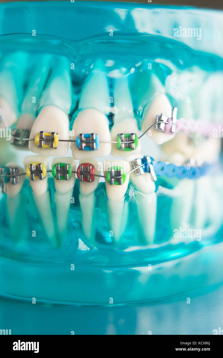 Dental teeth retainers metal aligners brackets to straighten teeth in ...