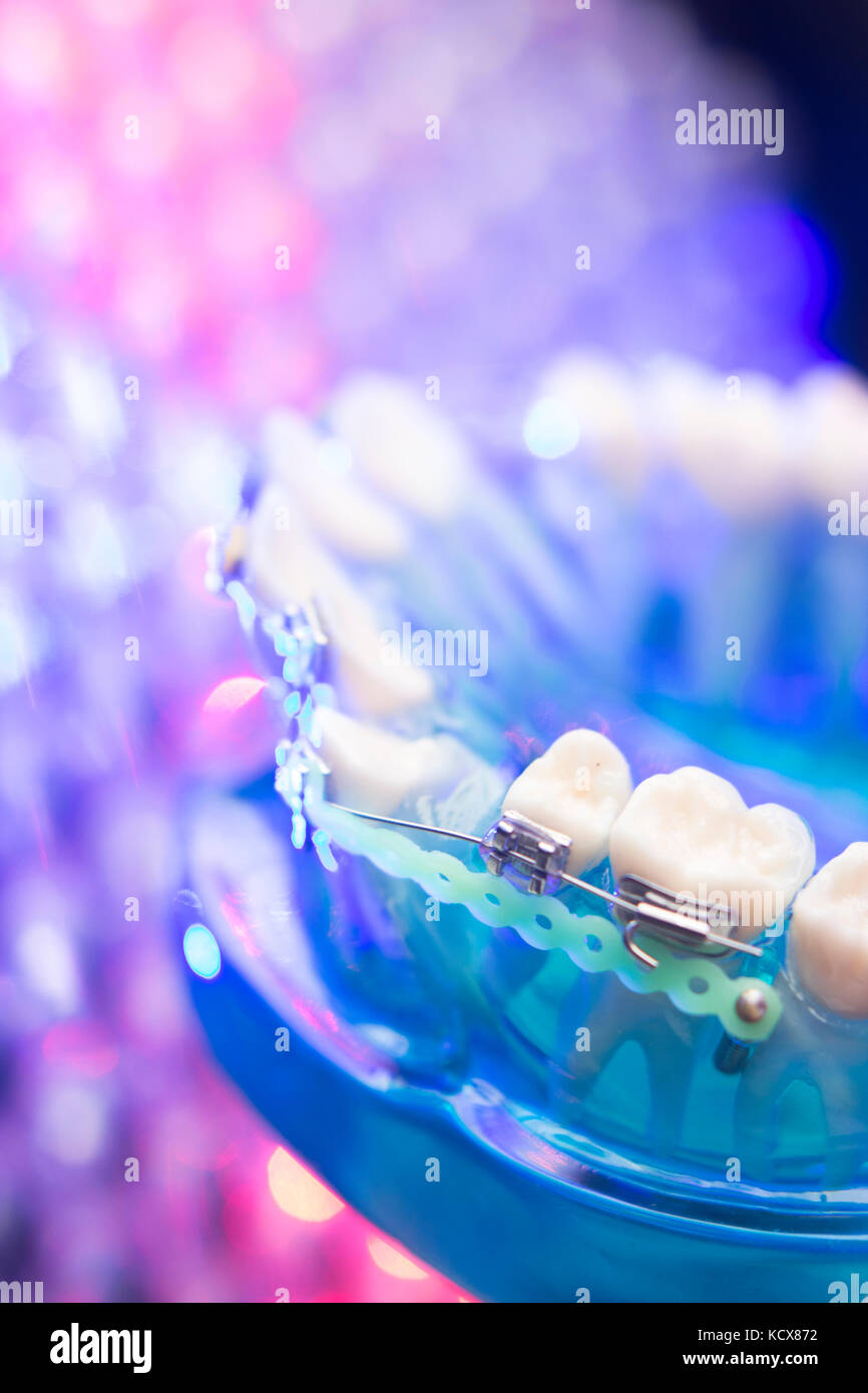 Dental teeth retainers metal aligners brackets to straighten teeth in ...