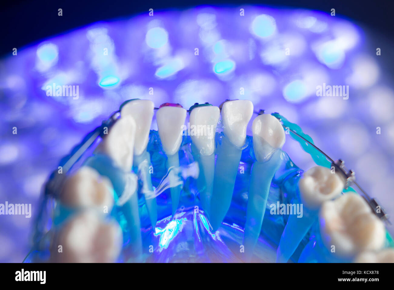 Dental teeth retainers metal aligners brackets to straighten teeth in ...