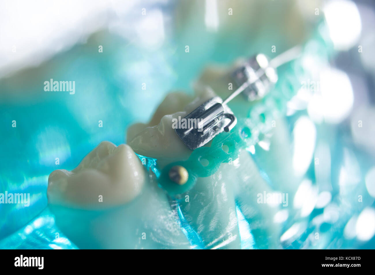 Dental teeth retainers metal aligners brackets to straighten teeth in ...