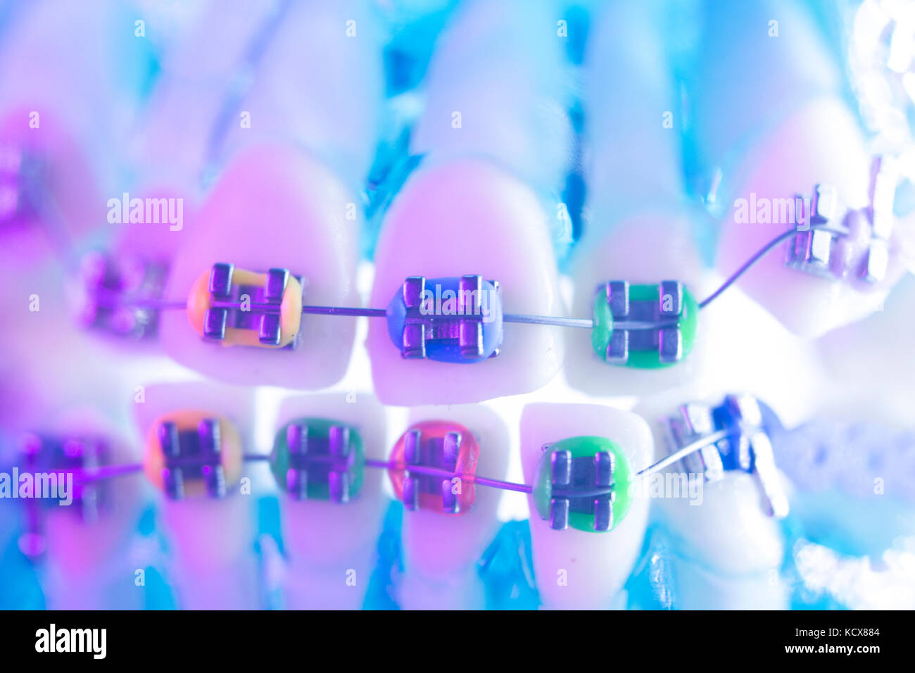 Dental teeth retainers metal aligners brackets to straighten teeth in ...