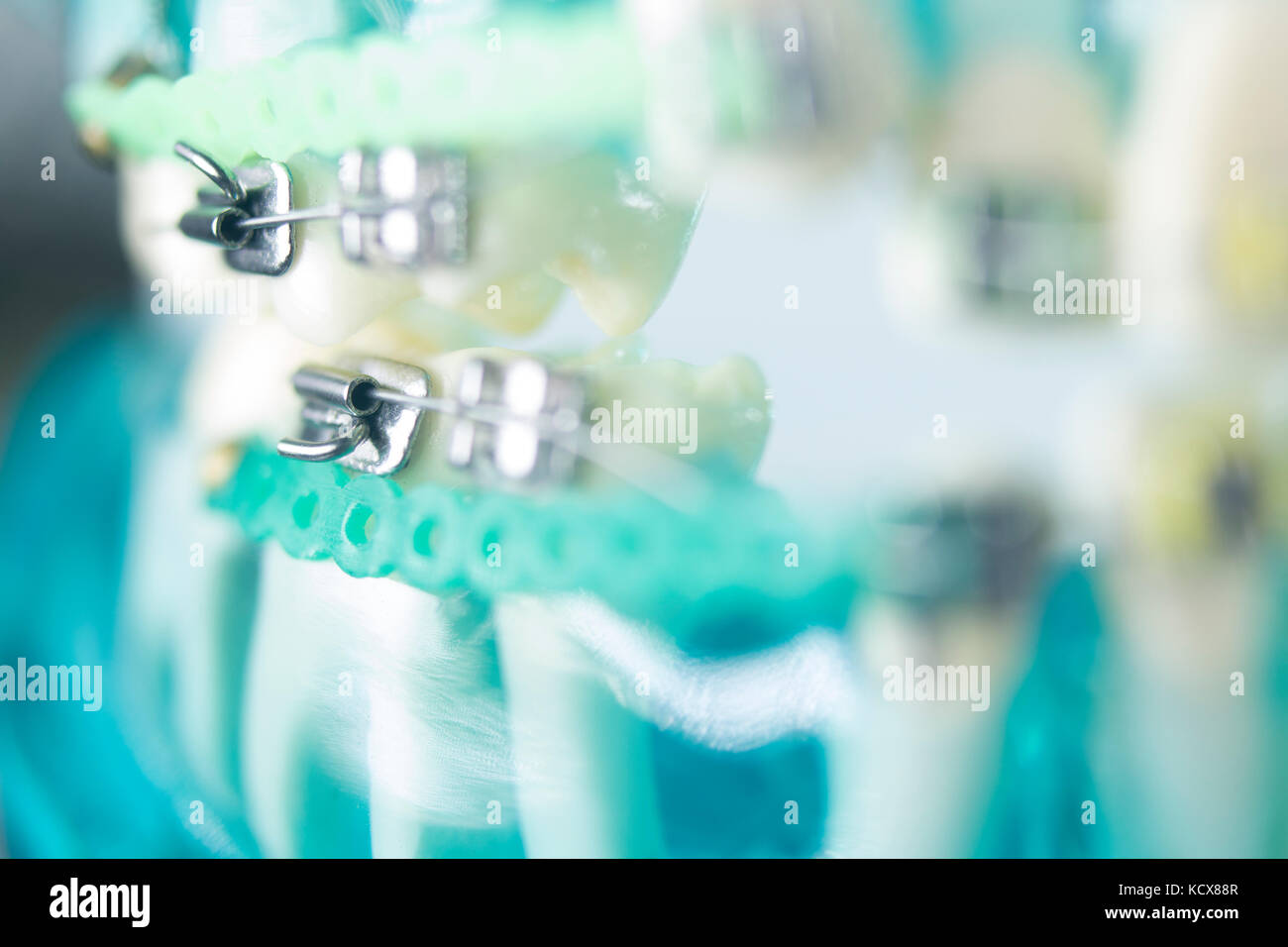 Dental teeth retainers metal aligners brackets to straighten teeth in ...