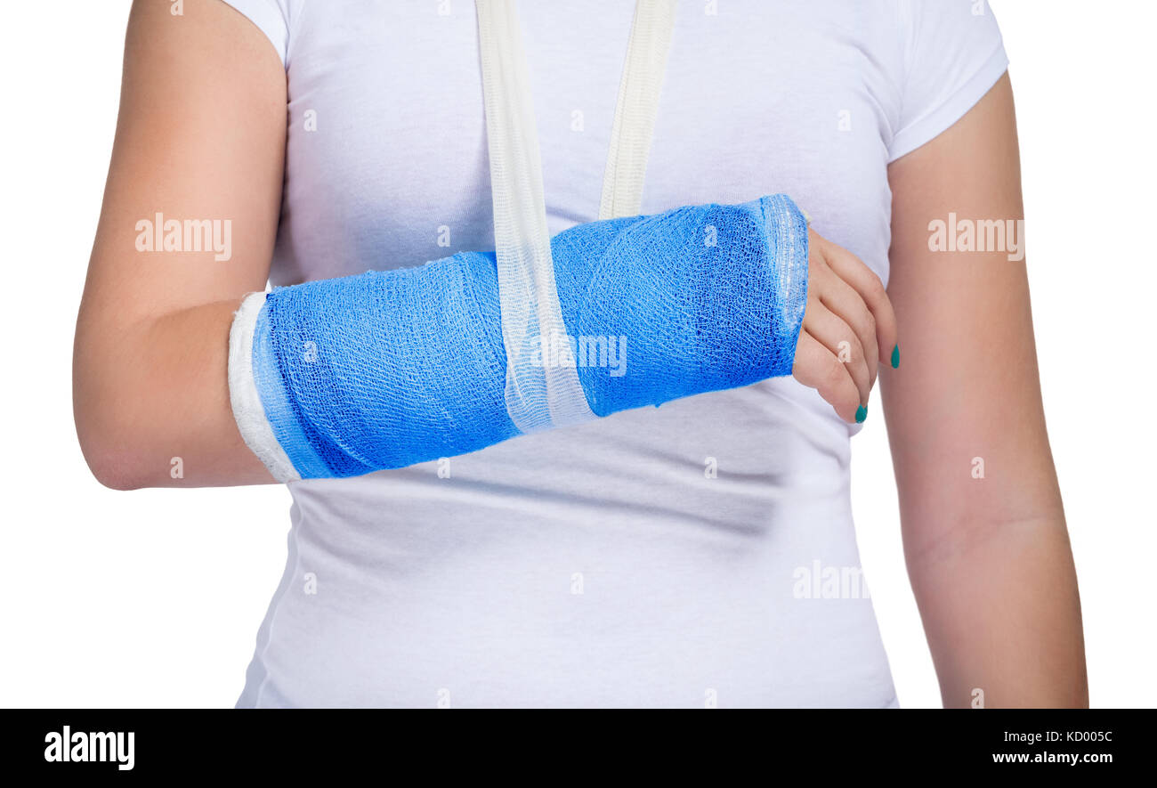 Female patient with a cast on arm, isolated on white background Stock ...