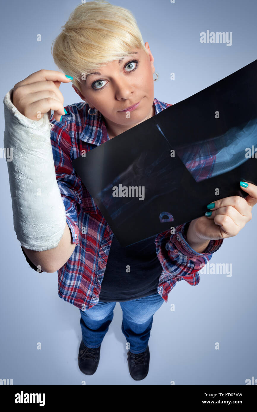X ray broken arm plaster cast hi-res stock photography and images - Alamy