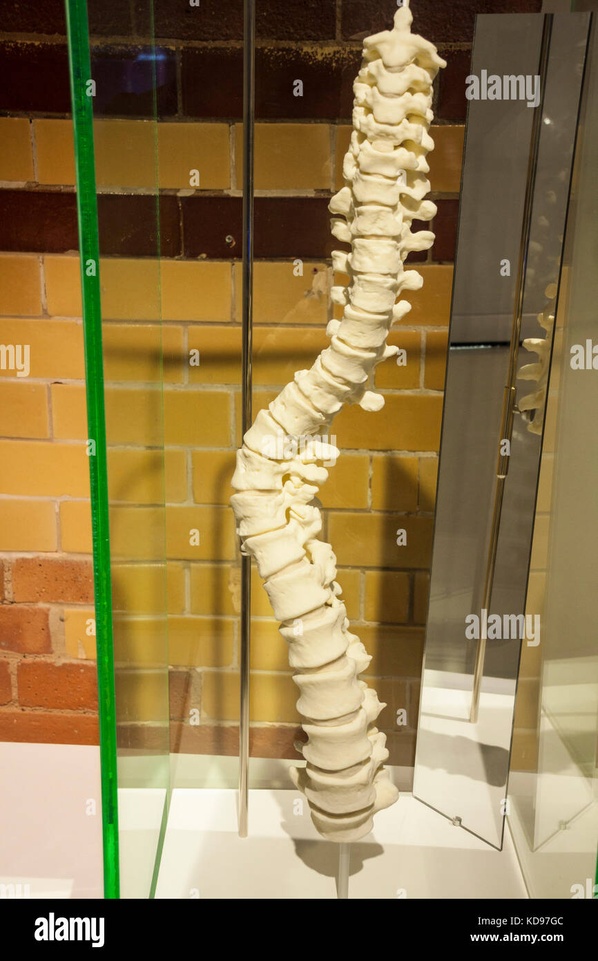 Reconstruction of the curved spine of RichardIII at exhibition in ...