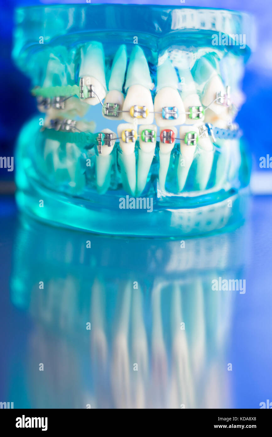 Dental teeth retainers metal aligners brackets to straighten teeth in ...