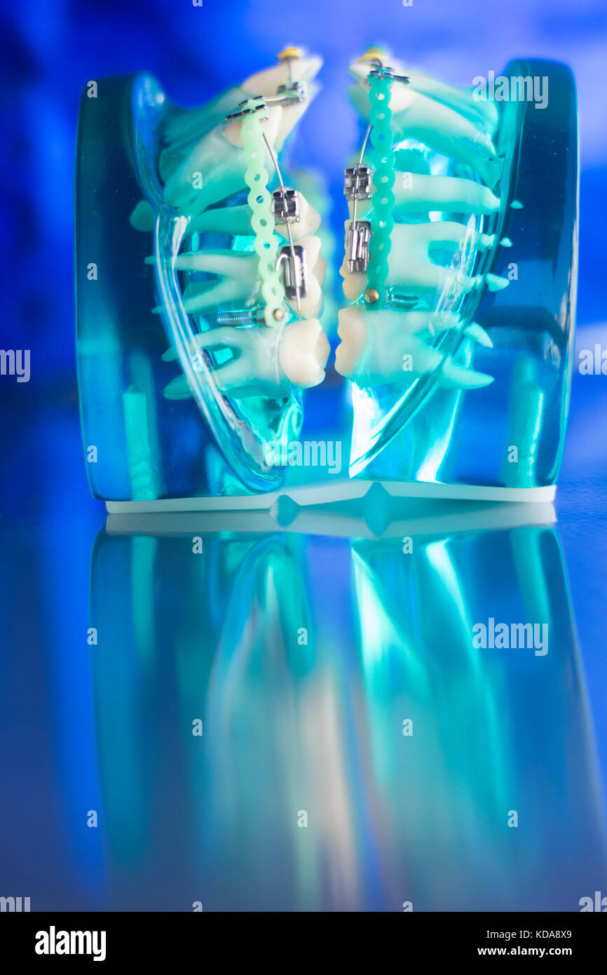 Dental teeth retainers metal aligners brackets to straighten teeth in ...