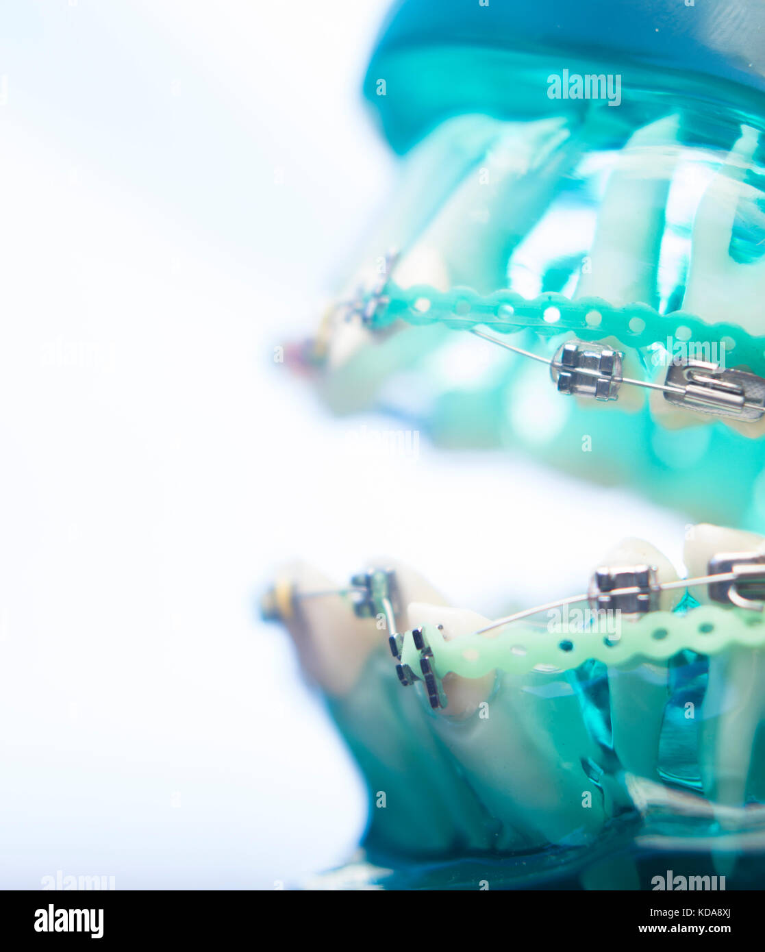 Dental teeth retainers metal aligners brackets to straighten teeth in ...