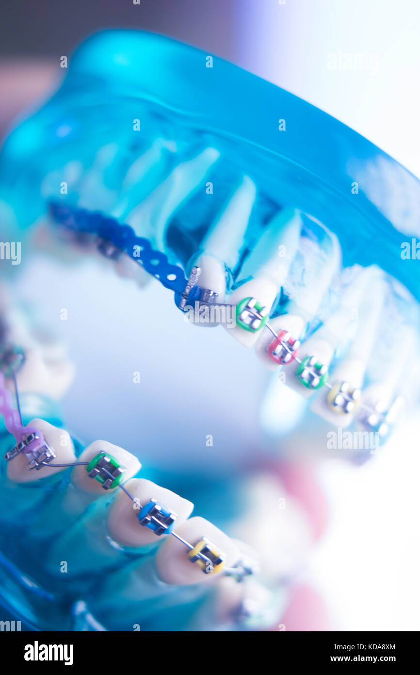 Dental teeth retainers metal aligners brackets to straighten teeth in ...