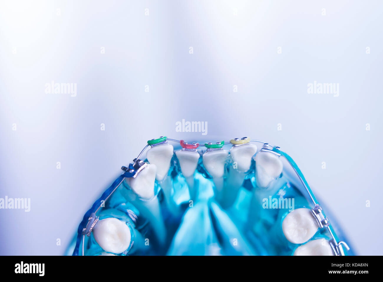 Dental teeth retainers metal aligners brackets to straighten teeth in ...