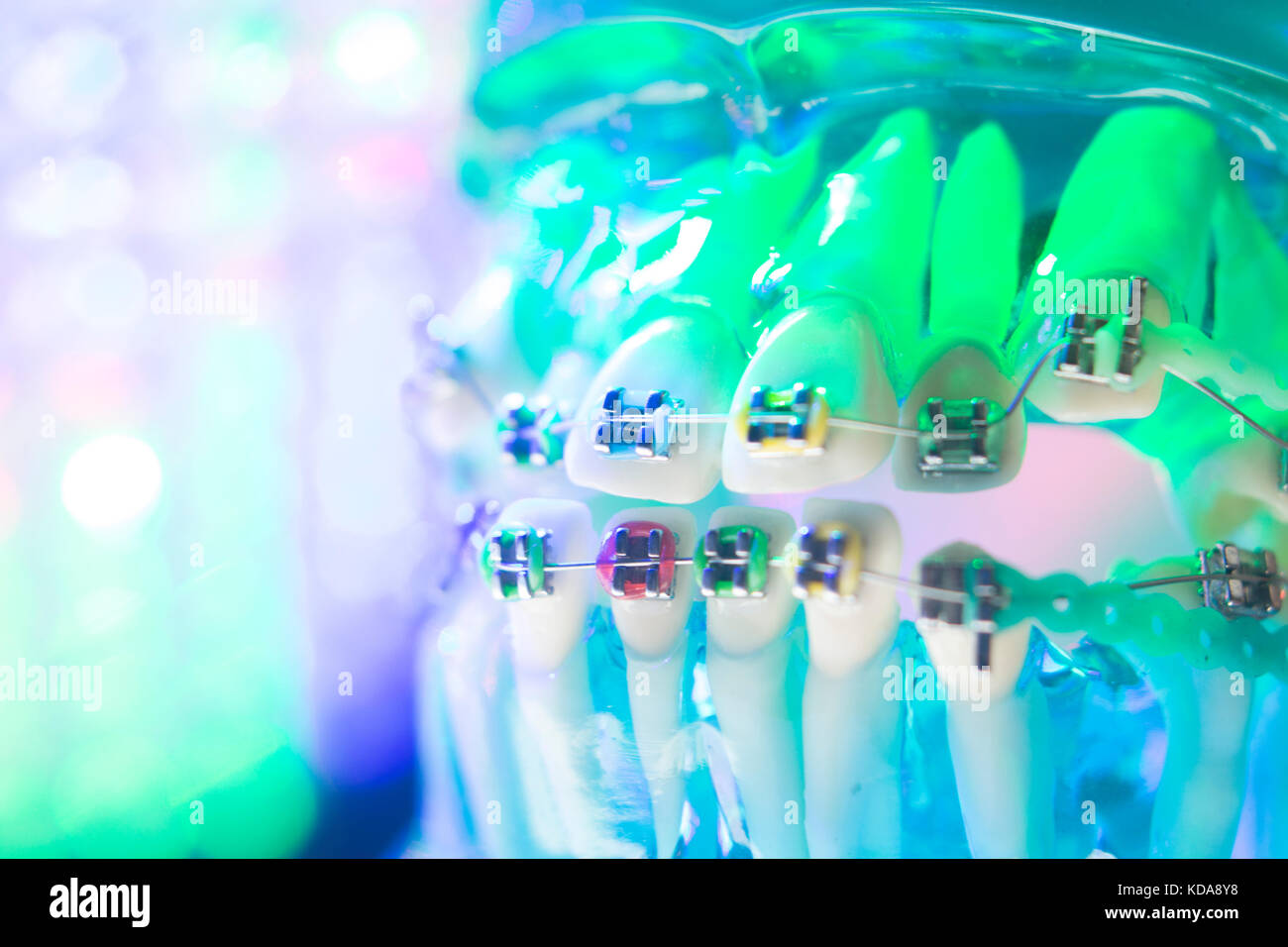 Dental teeth retainers metal aligners brackets to straighten teeth in ...