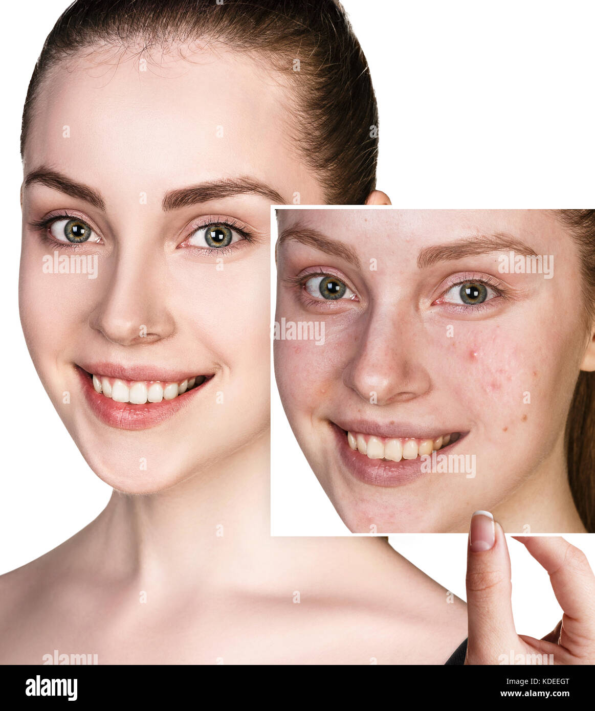 Woman shows photo with bad skin before treatment Stock Photo - Alamy