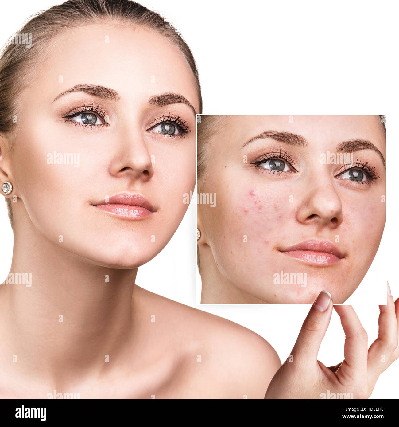 Woman shows photo with bad skin before treatment Stock Photo - Alamy