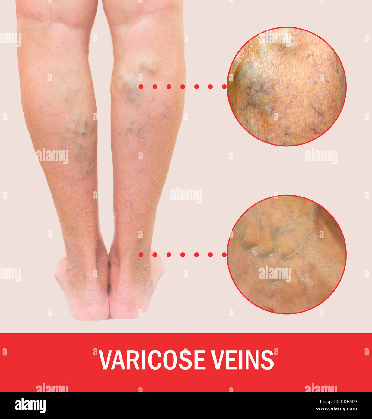 Painful varicose veins,,spider veins, varices on a severely affected ...