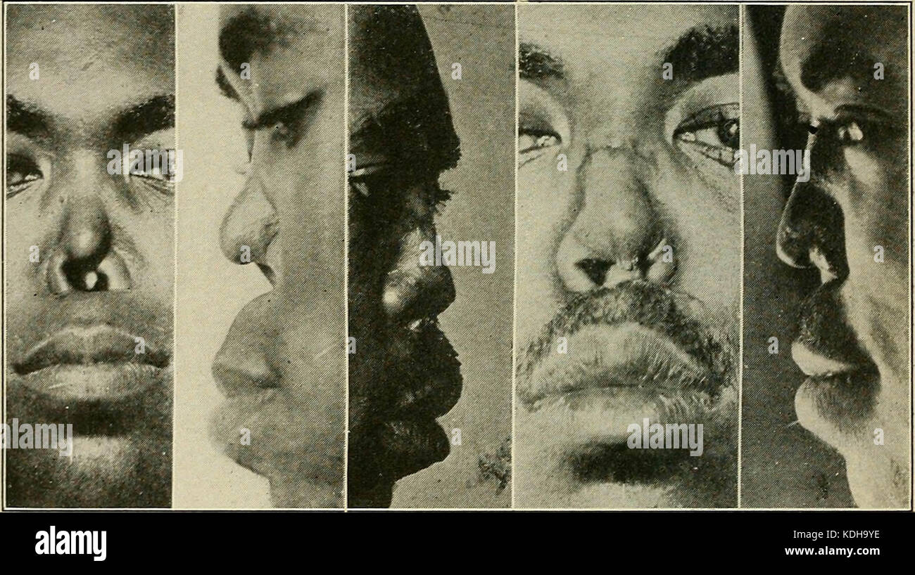 "Plastic surgery; its principles and practice" (1919 Stock Photo - Alamy